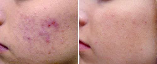 Acne Treatment - A Miracle Aesthetic and Wellness Center in Ohio, Parma ...